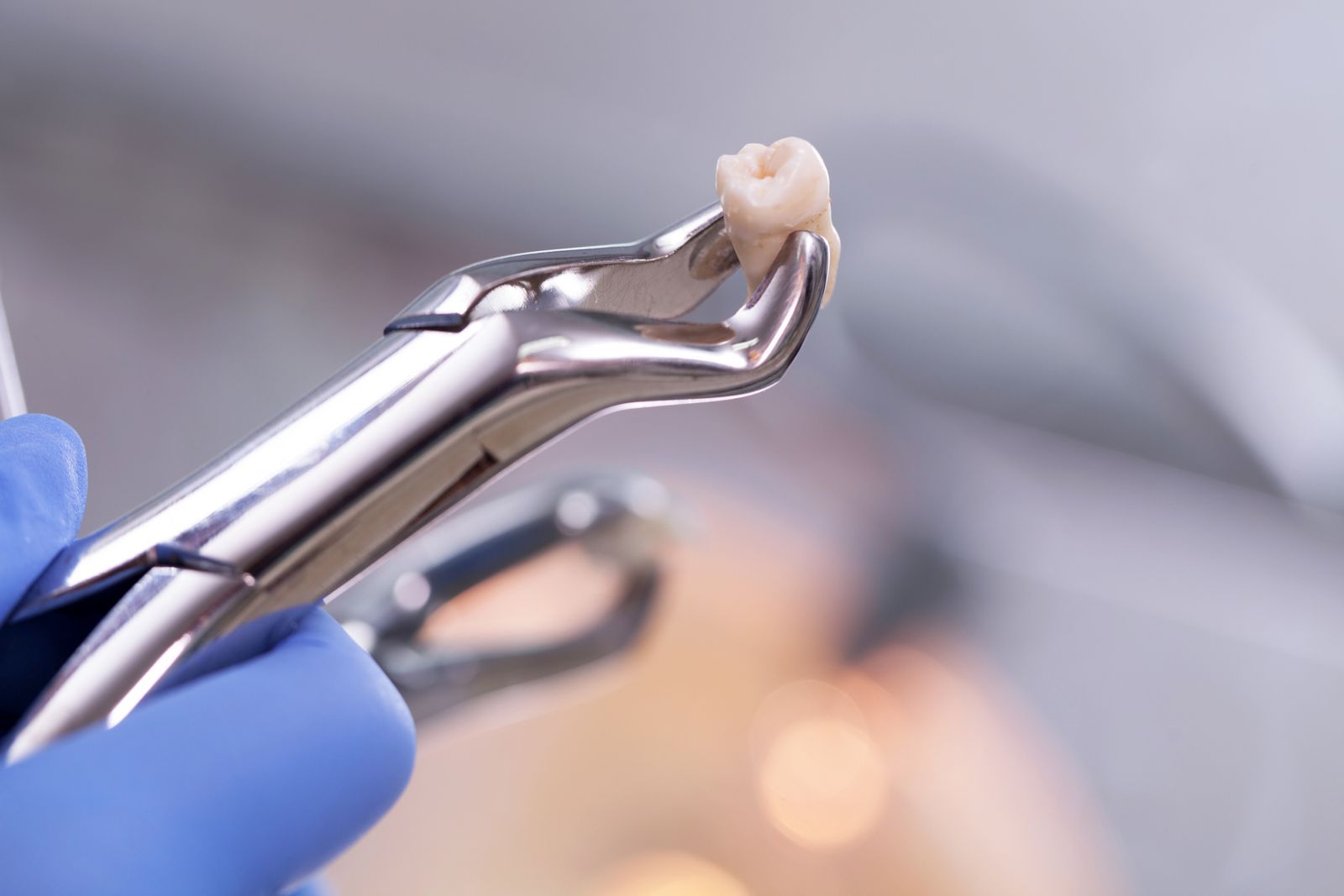 Safe and Comfortable Tooth Extraction Services in Dallas