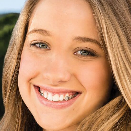 Advantages of Using Carriere Motion And Carriere Braces