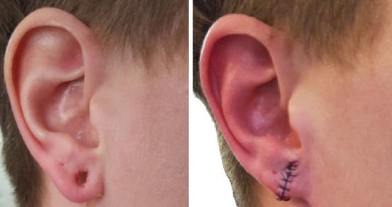 Earlobe Repair Surgery | Calgary, AB | Derm.ca