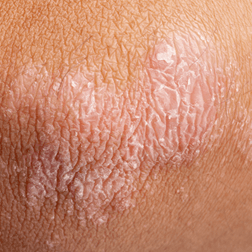 Common Skin Conditions | Shelby, MI | Dermatology Specialists of Shelby