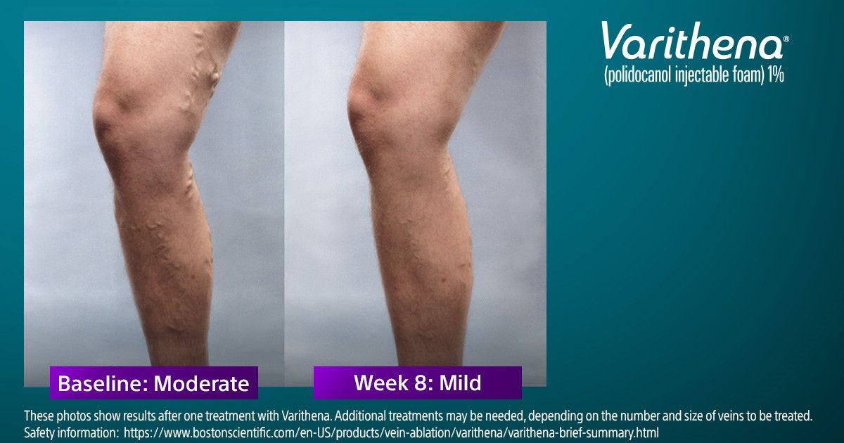 Varithena Varicose Vein Ablation In Ormond Beach Fl