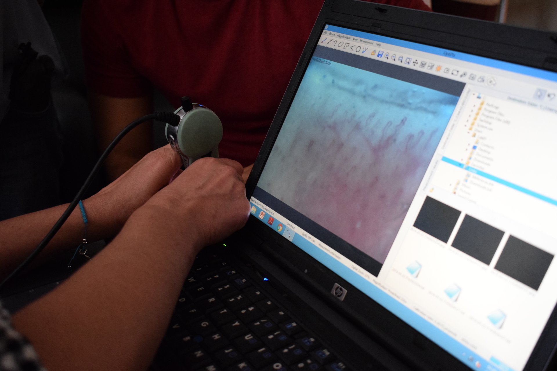 Curso de Capilaroscopía 2019 | Reumatología Perú