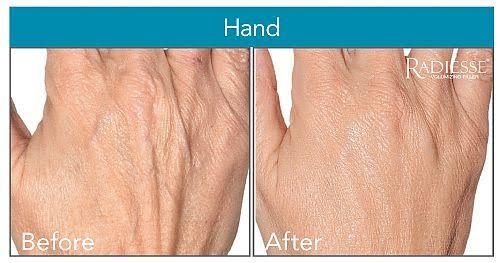 Asfa Plastic Surgery | Hand Rejuvenation