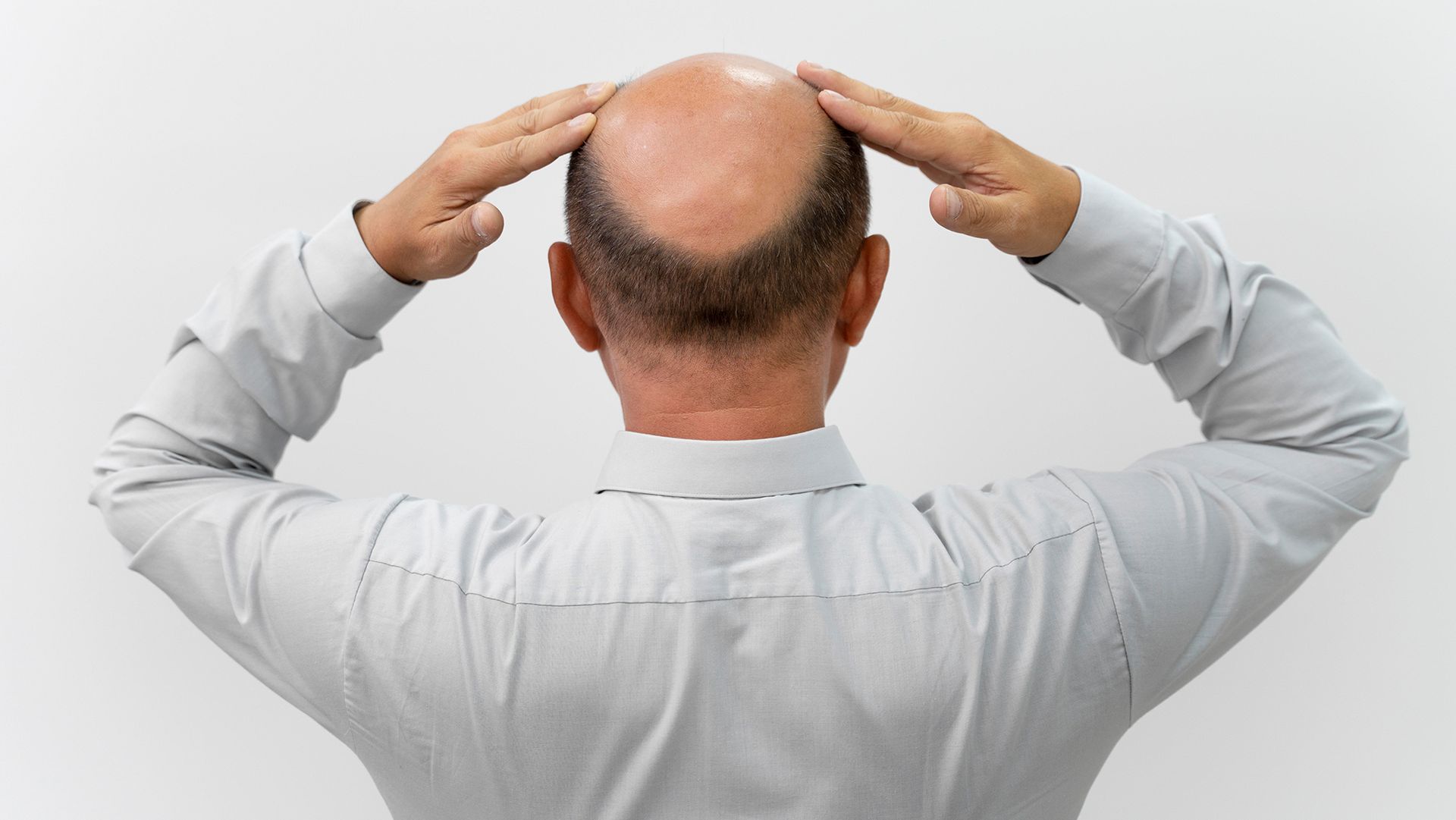 How to Cover Up Balding Crown and Other Signs of Hair Loss