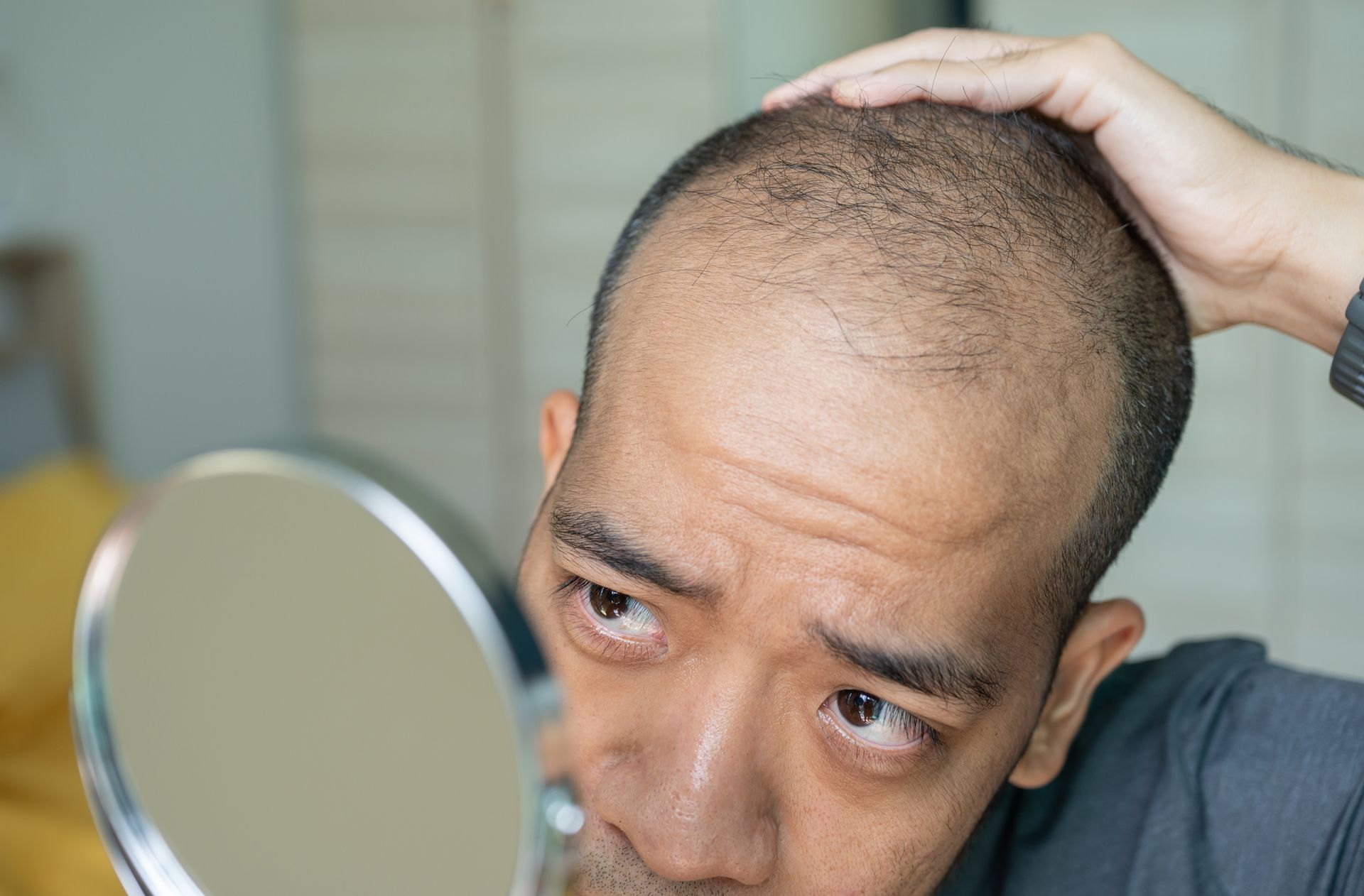 Understanding Men’s Balding and Male Pattern Baldness