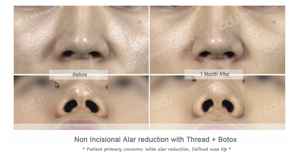 Alar Reduction Surgery in Seoul | Gangnam Plastic Surgery Clinic & Cost