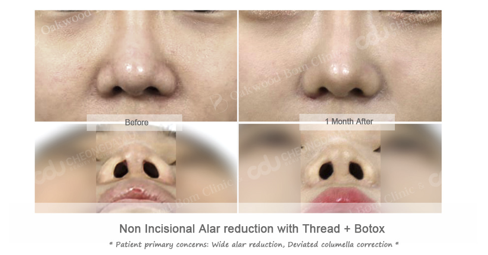 Bulbose Nose Rhinoplasty in Seoul | Gangnam Arc Plastic Surgery Clinic ...