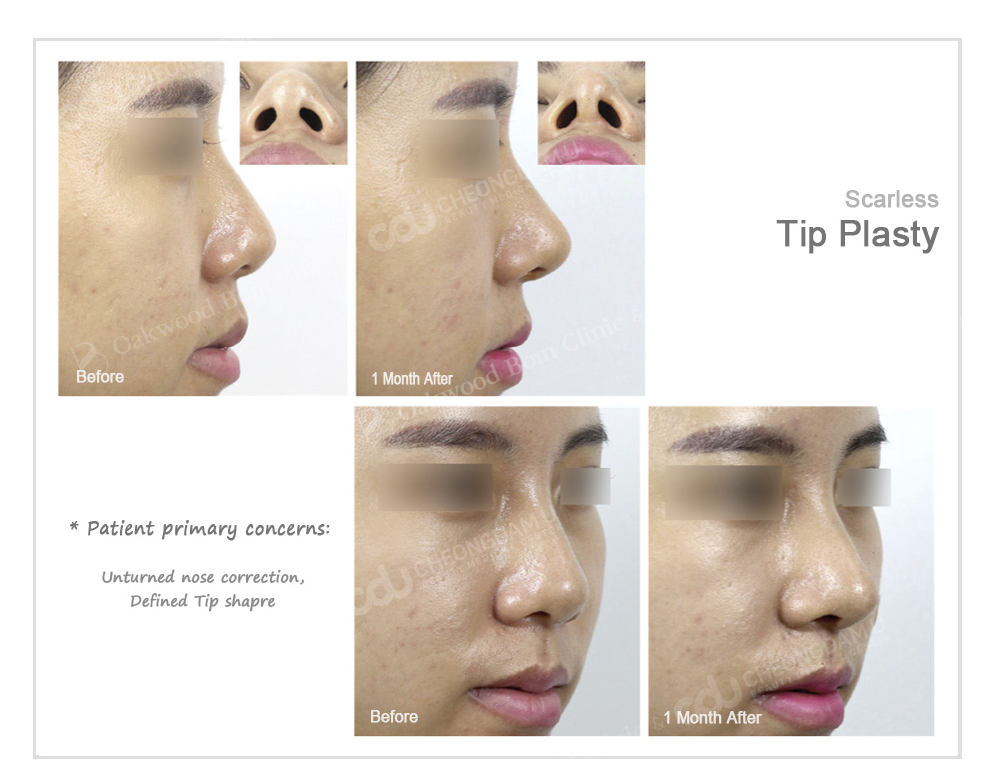 Bulbose Nose Rhinoplasty in Seoul | Gangnam Arc Plastic Surgery Clinic ...