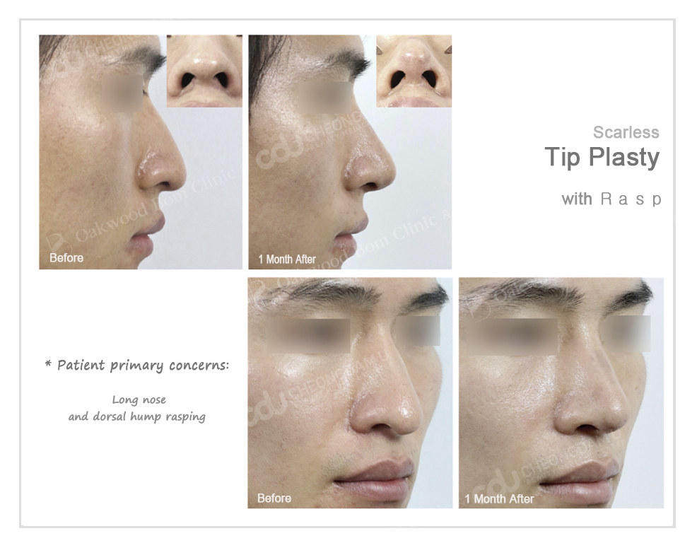 Bulbose Nose Rhinoplasty in Seoul | Gangnam Arc Plastic Surgery Clinic ...