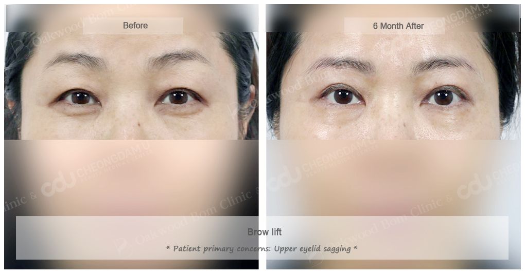 Double Eyelid Surgery in Seoul | Gangnam Eye Surgery Clinic & Cost
