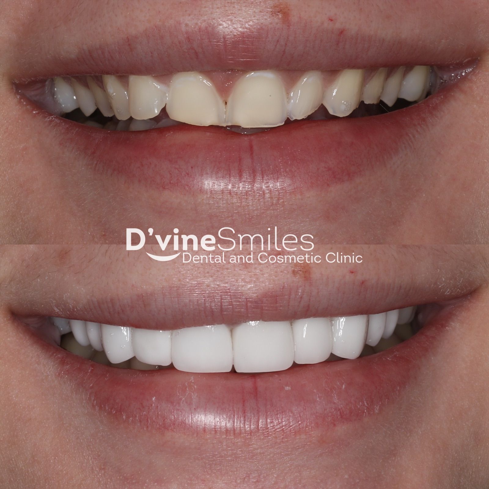 Veneer Results | Melbourne, VIC | D'vine Smiles