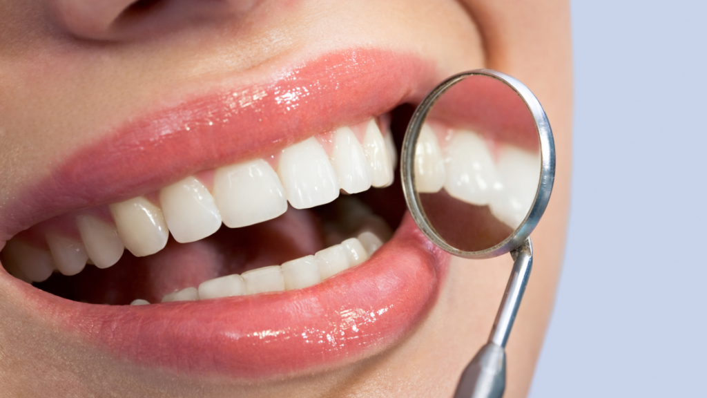 How Long Do White Spots On Teeth Last After Whitening
