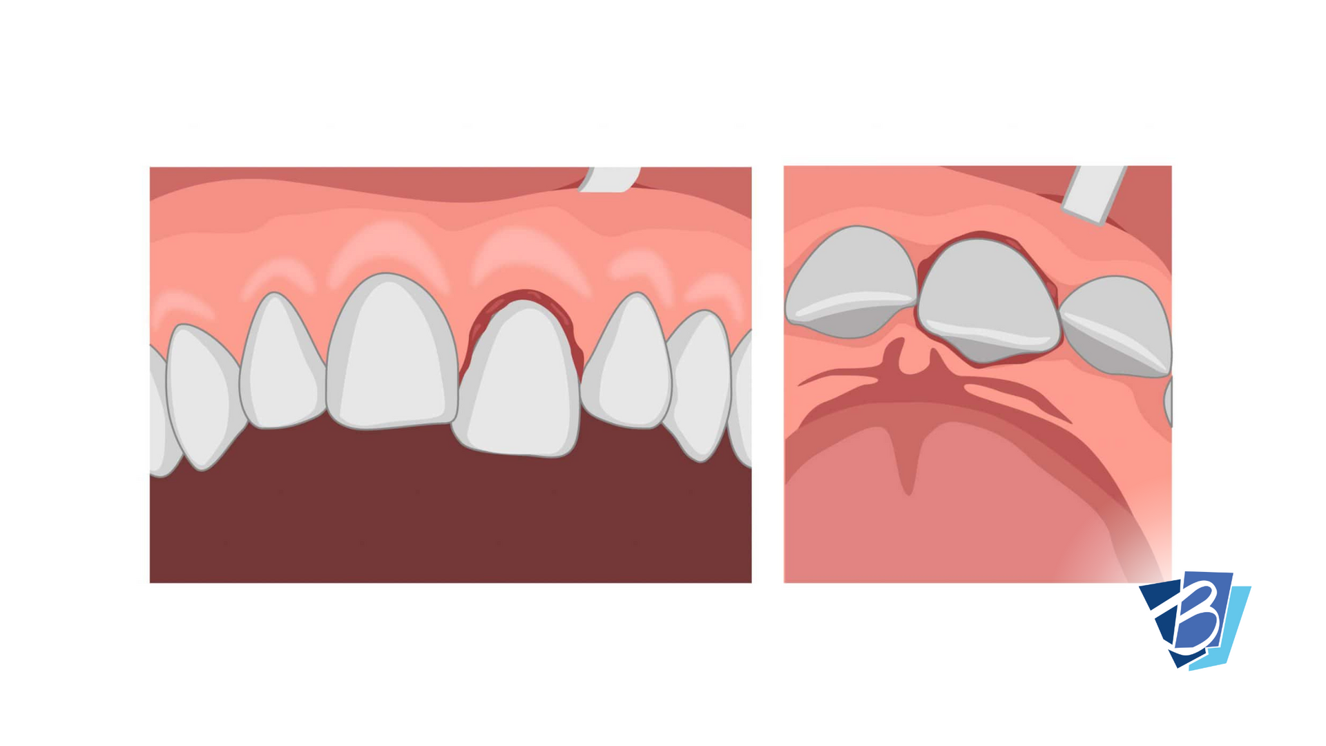 Tooth Luxation: Types, Causes, Symptoms, and Treatment