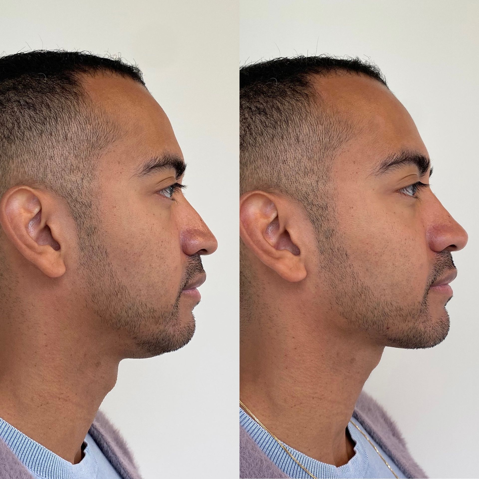 Professionele Kin Correctie | Cosmopolitan Clinic Amsterdam