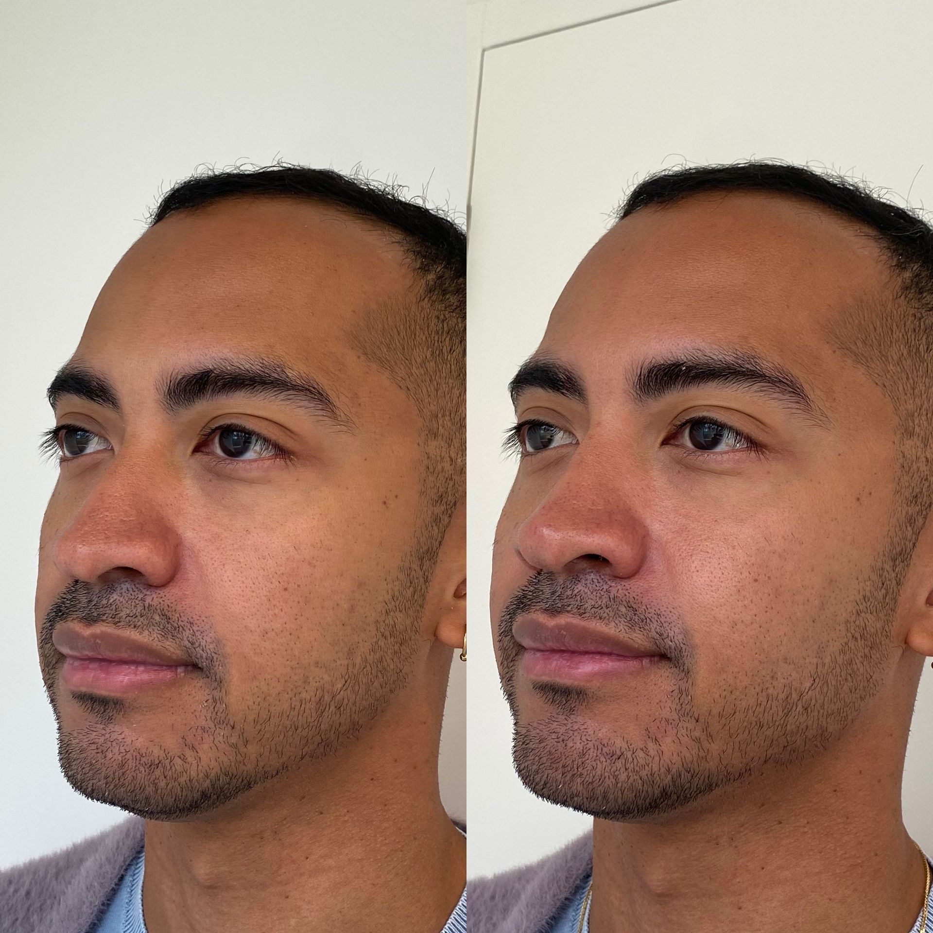 Professionele Kin Correctie | Cosmopolitan Clinic Amsterdam