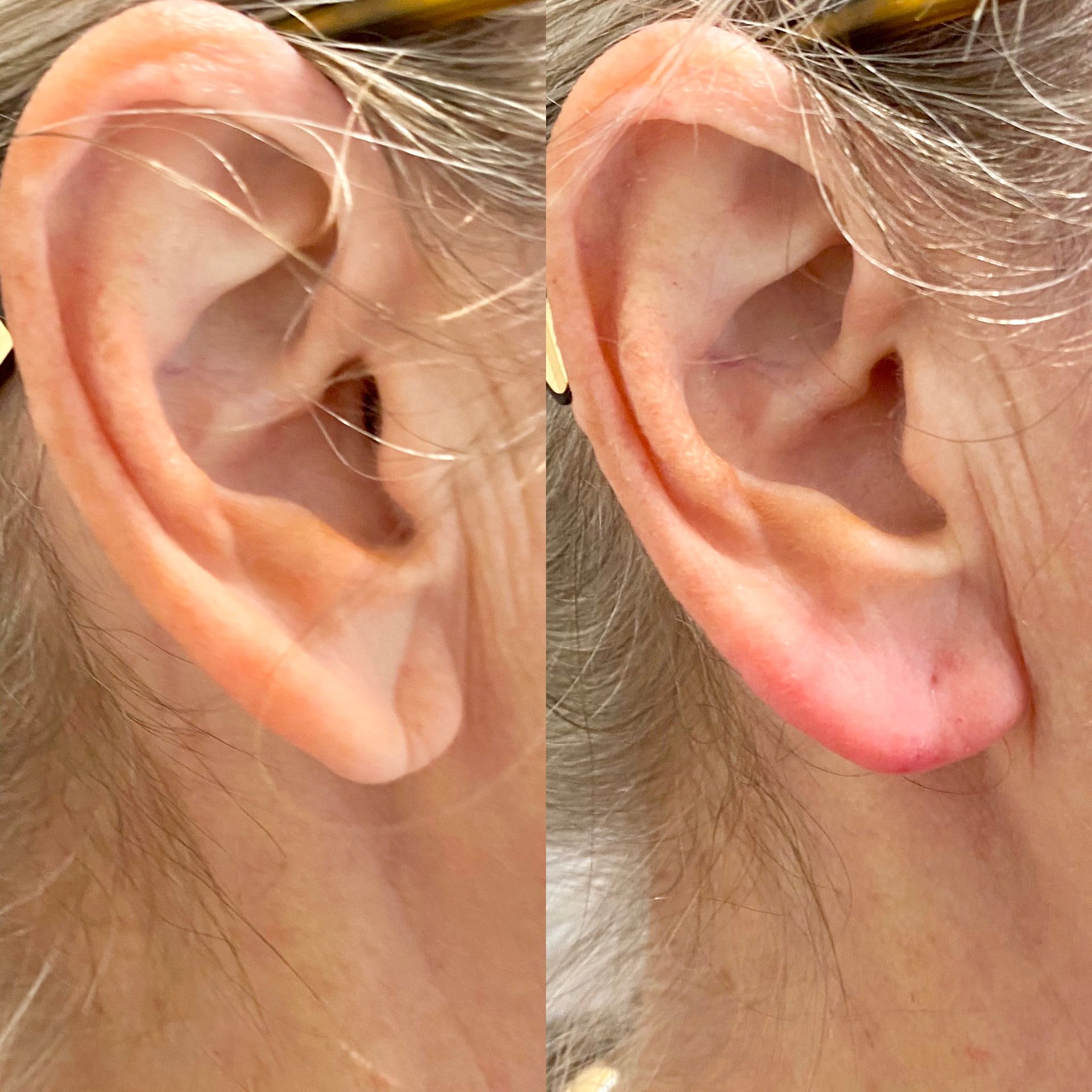 Oorlel Filler Behandeling | Cosmopolitan Clinic Amsterdam | Amsterdam