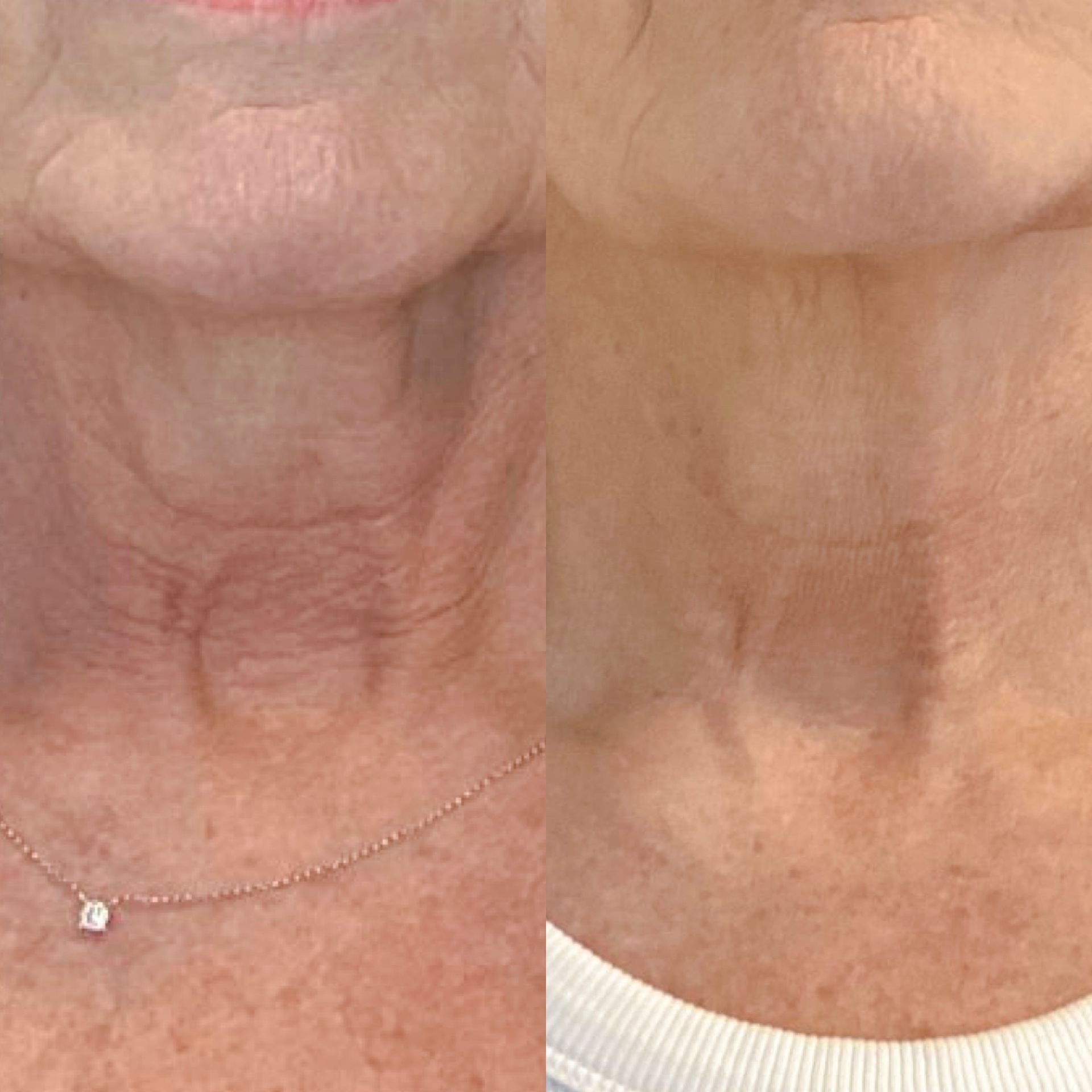 Profhilo | Cosmopolitan Clinic Amsterdam | Amsterdam