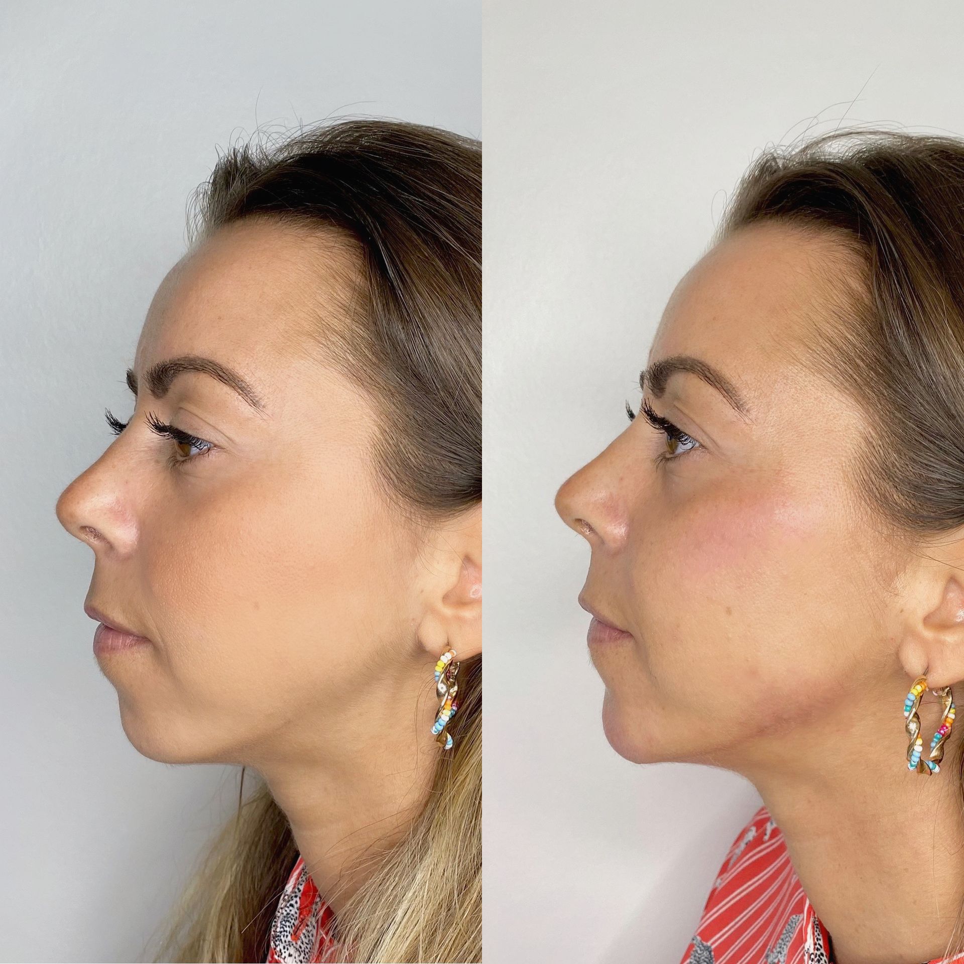 Professionele Kin Correctie | Cosmopolitan Clinic Amsterdam