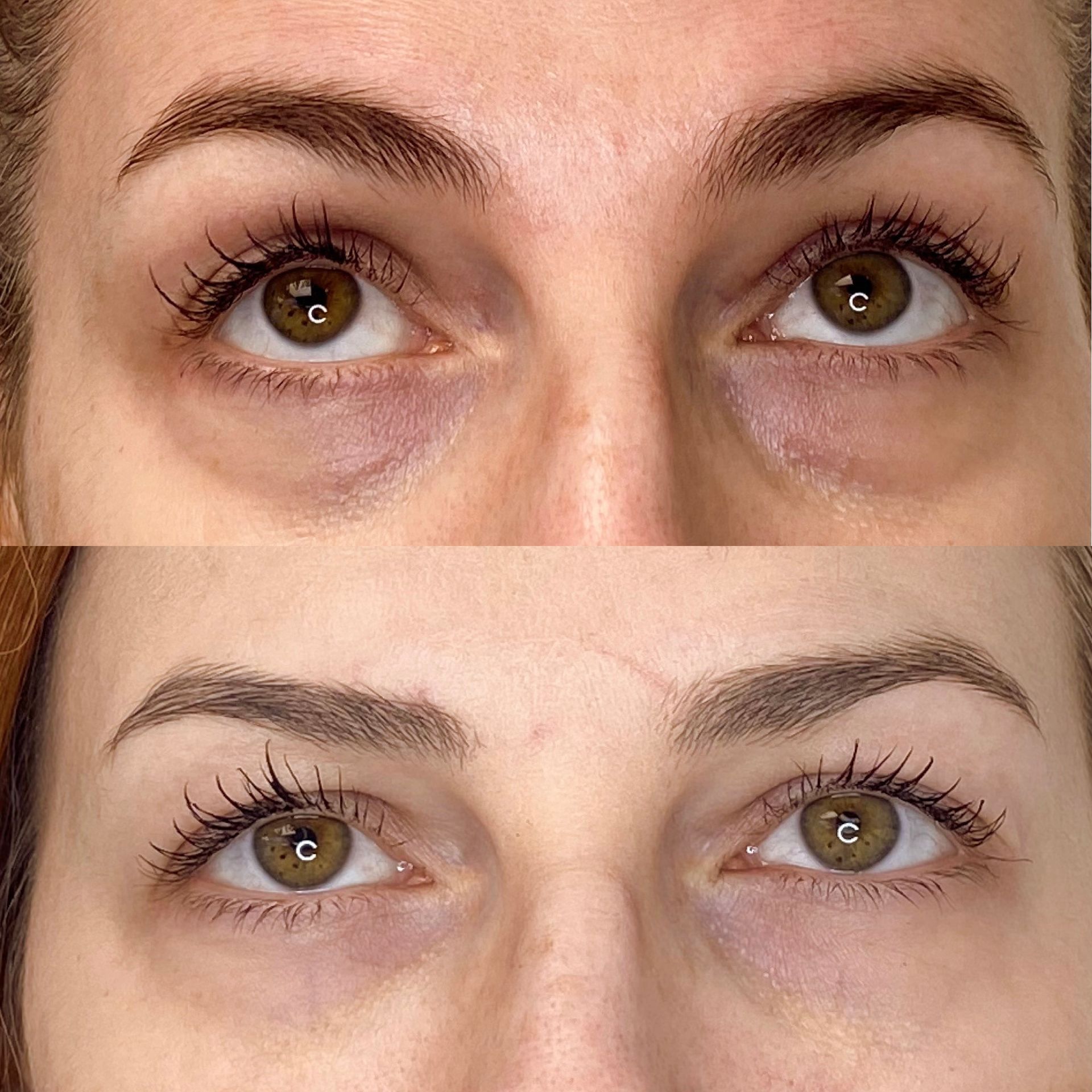 Traangoten Behandeling | Cosmopolitan Clinic Amsterdam | Amsterdam