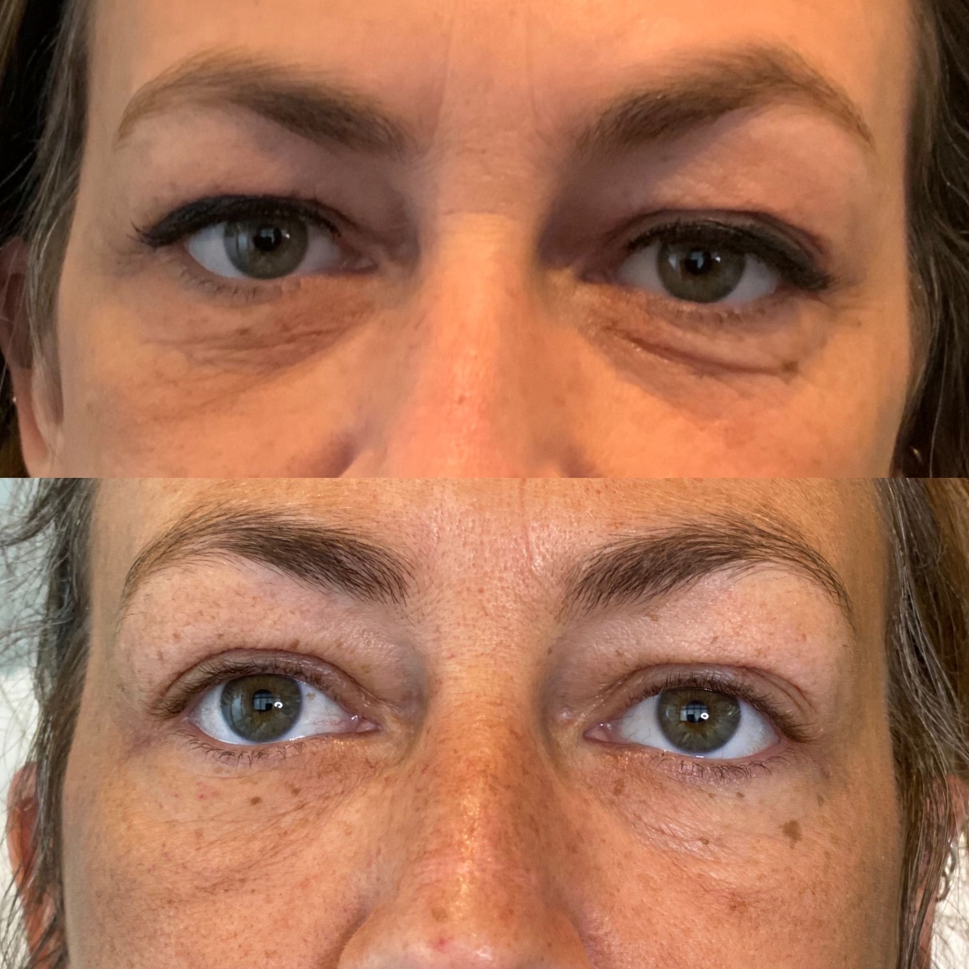 Dermal & HA Fillers | Modern You Medical Aesthetics | Burlington