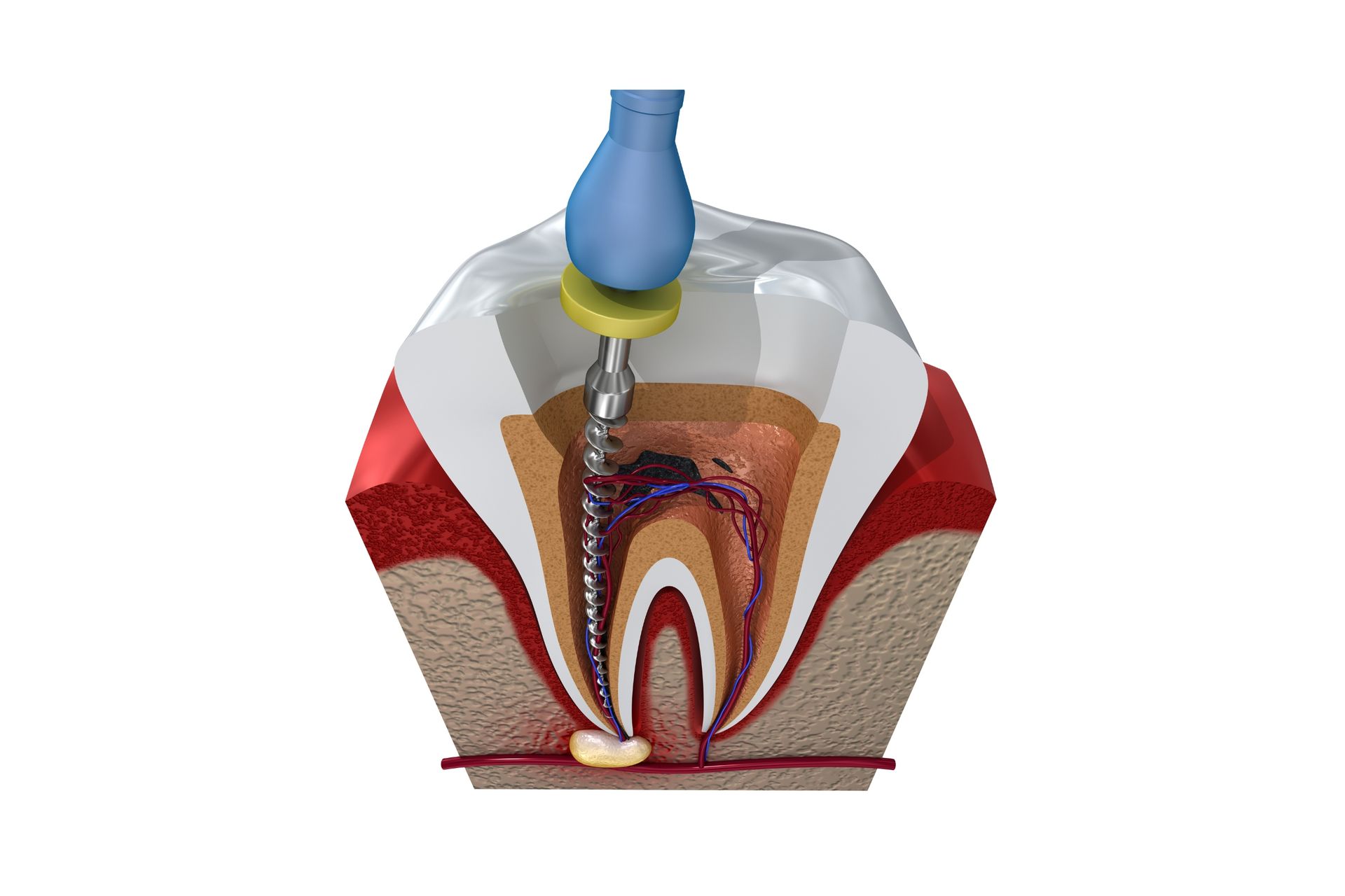 Demystifying The Root Canal Procedure: Facts And Myths Unveiled