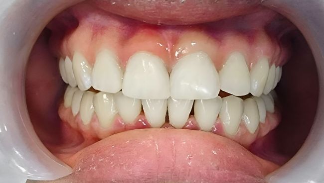 Invisalign Before And After Pictures Gallery