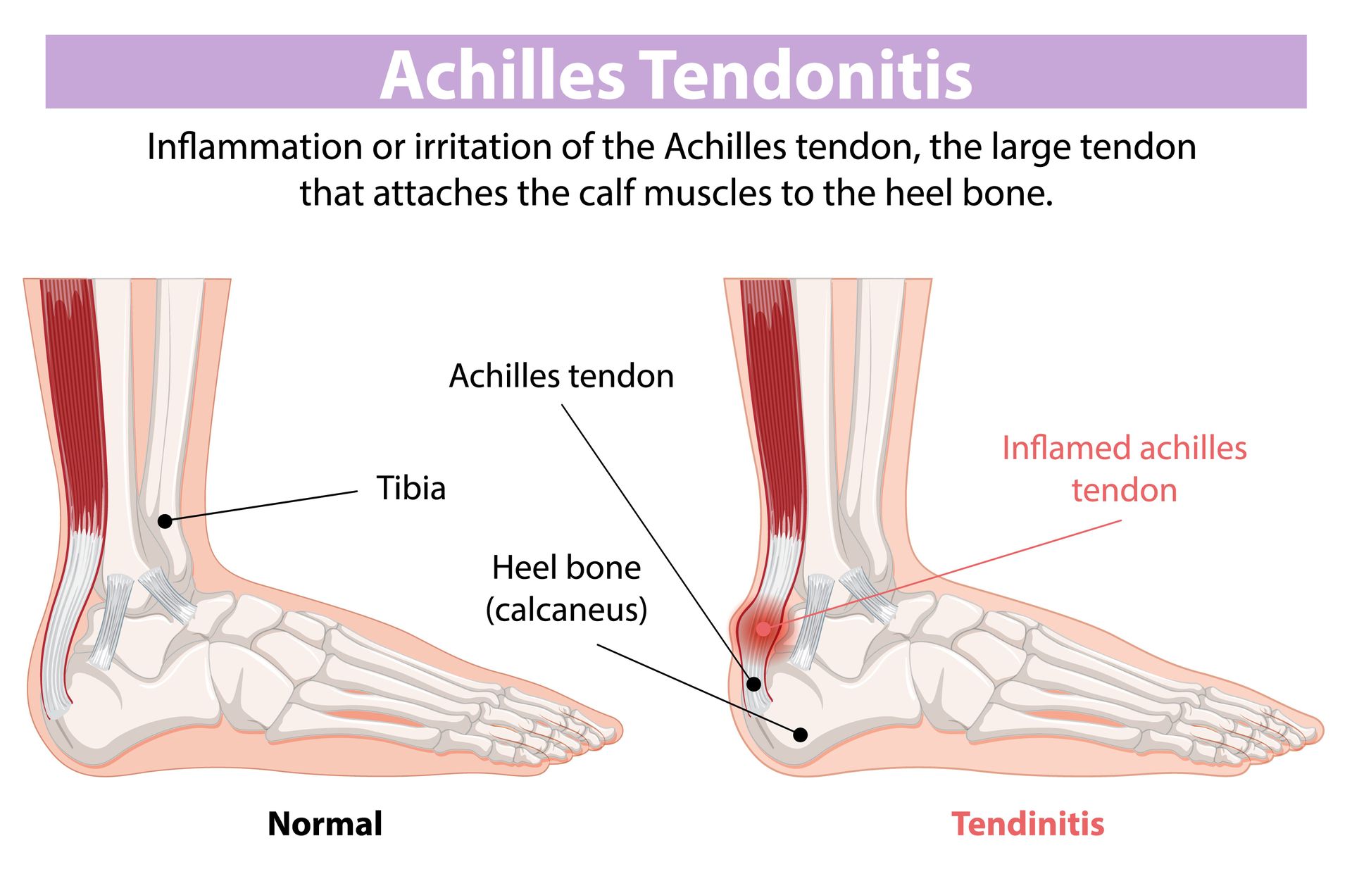 Achilles Tendon Rupture Chiro Treatment in Adelaide