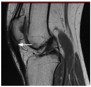 Tendinite patelar: causas e tratamento