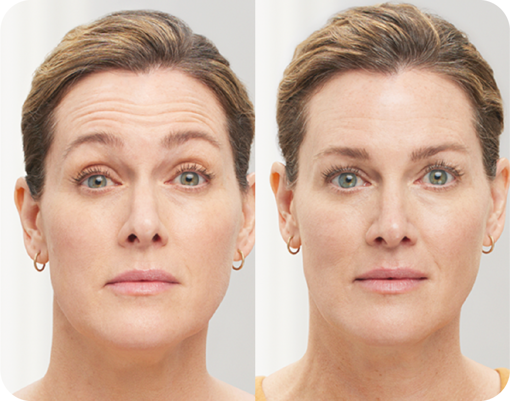 Tox Treatments | Holos Medical Spa