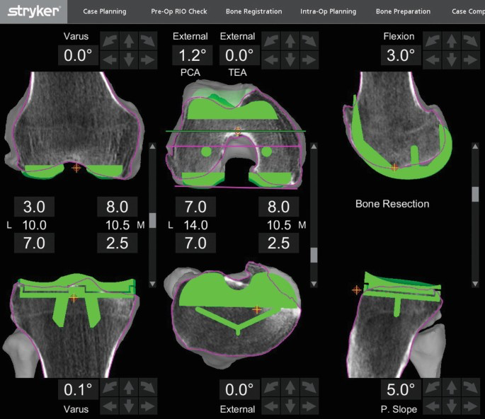 Dr Leie | Orthopaedic Surgeon Perth | Robotic Total Knee Replacement