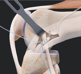 Dr Leie | Orthopaedic Surgeon Perth | Anterior Cruciate Ligament ...