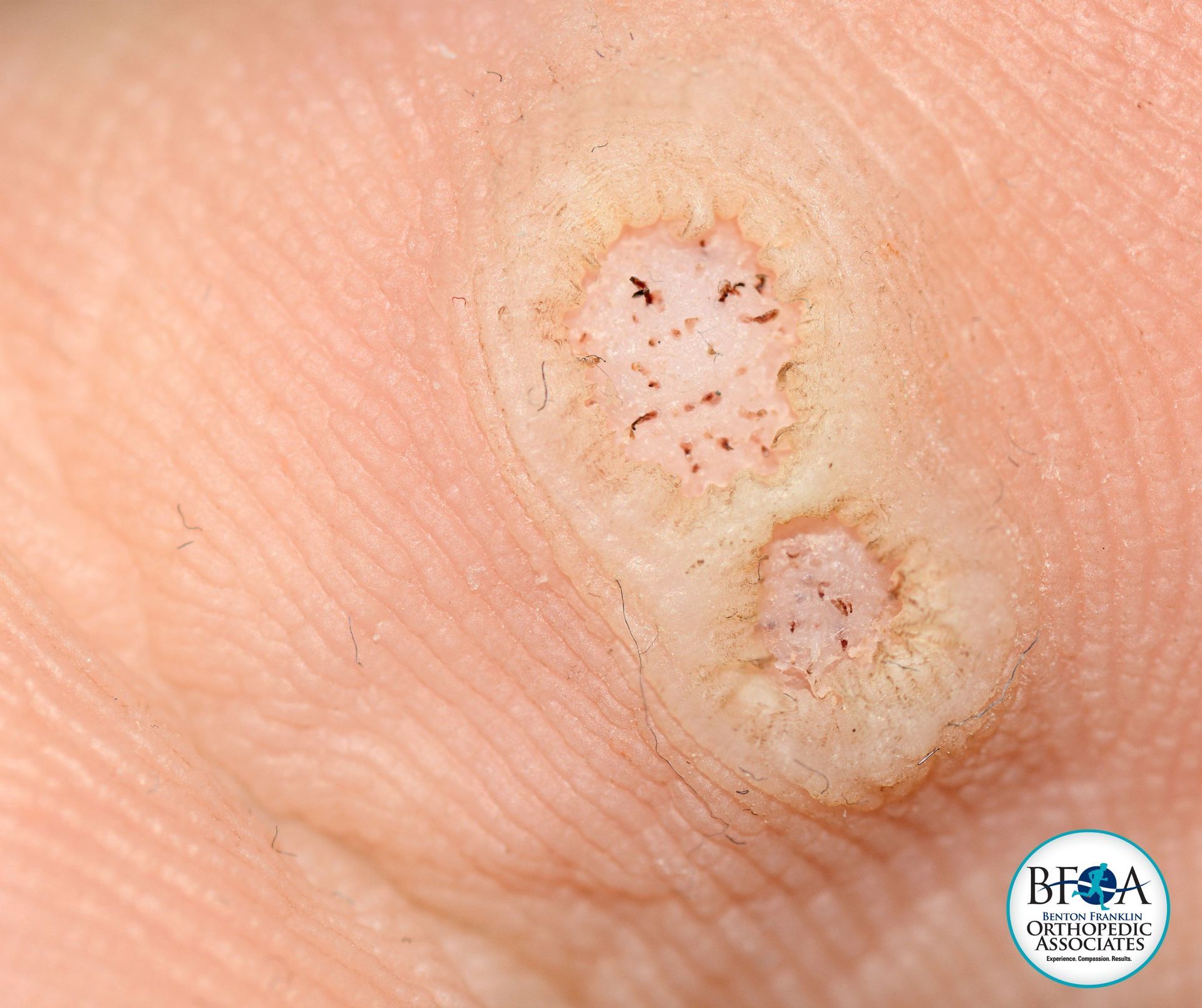 Plantar Warts in Kennewick, WA