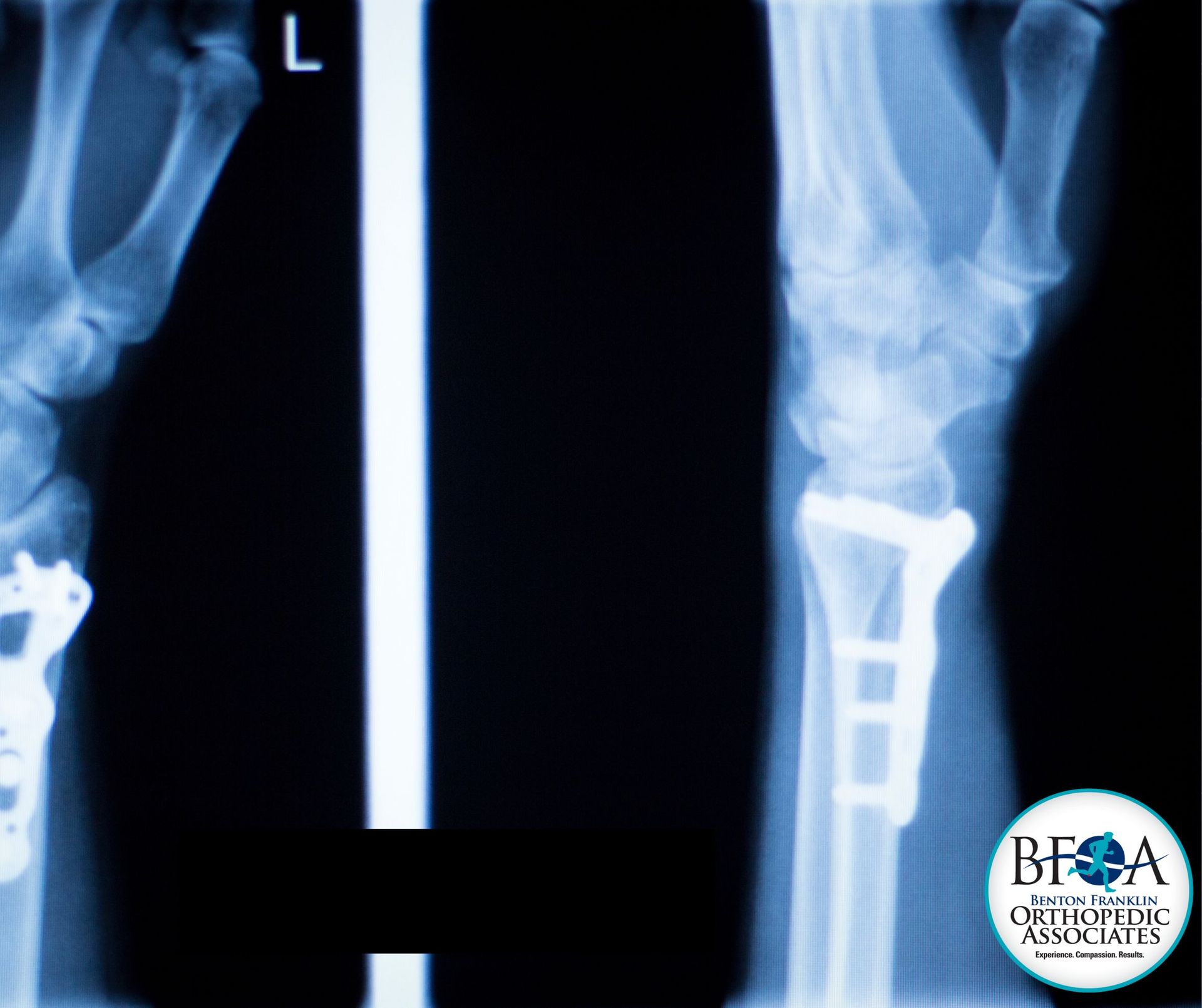 Ulnar Impaction Syndrome in Kennewick, WA