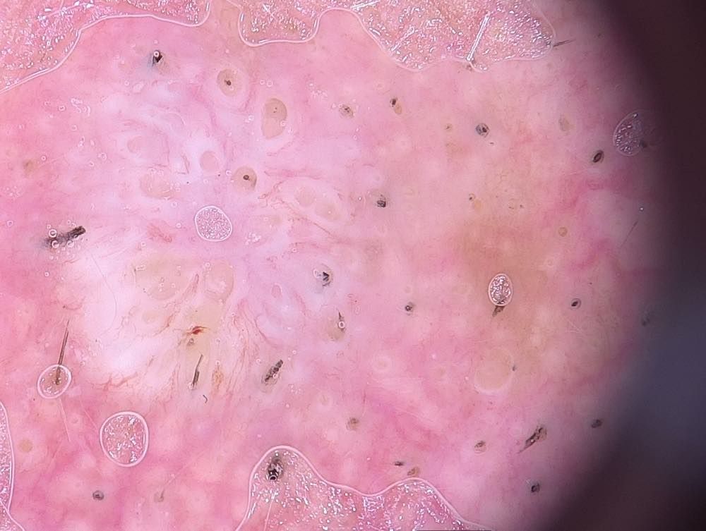 Skin Cancer Checks | Koo Wee Rup, VIC | Icarus Clinic