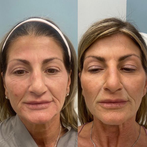Aerolase Laser NYC | Aesthetic Skin Resurfacing