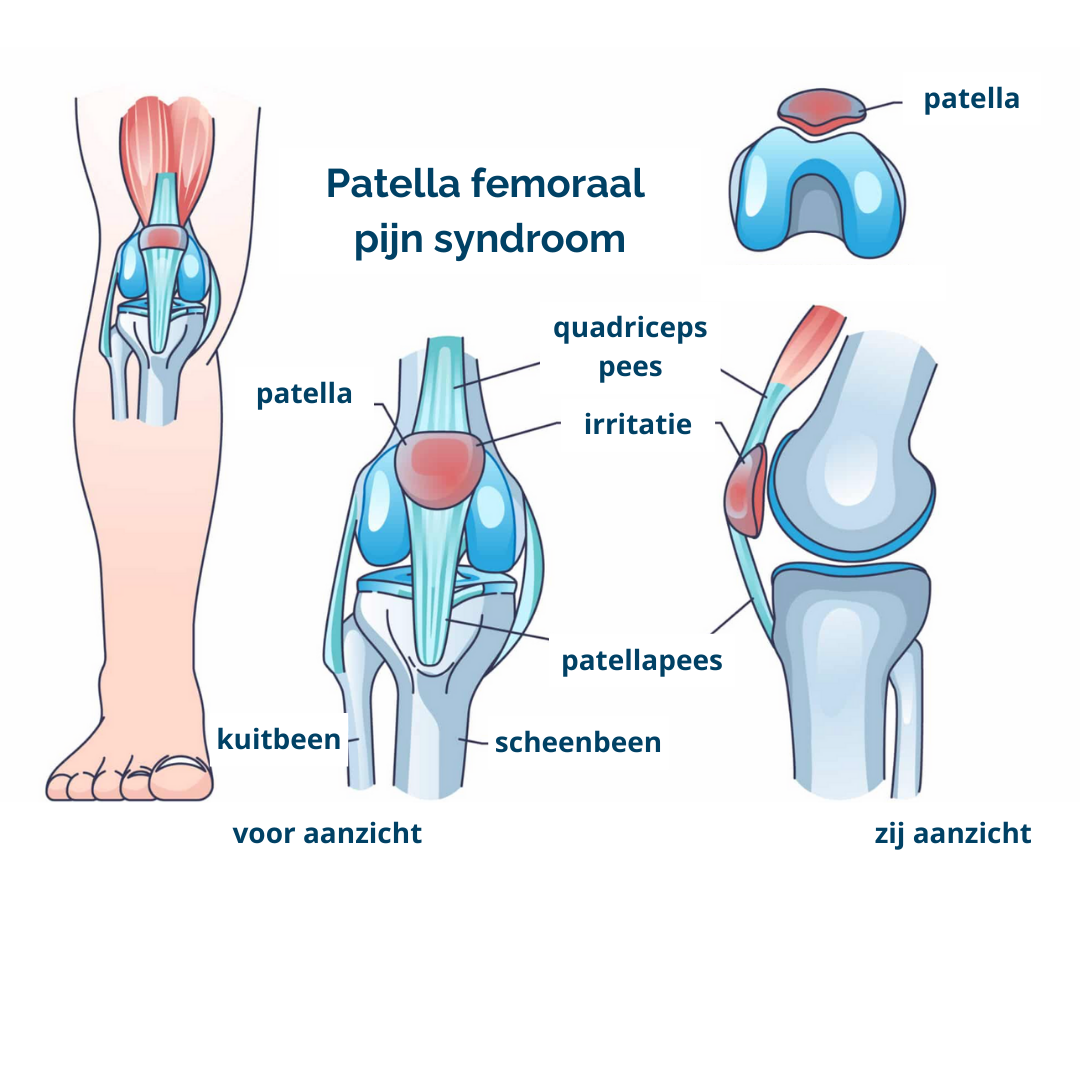 Knieschijf Klachten | Flow Fysio