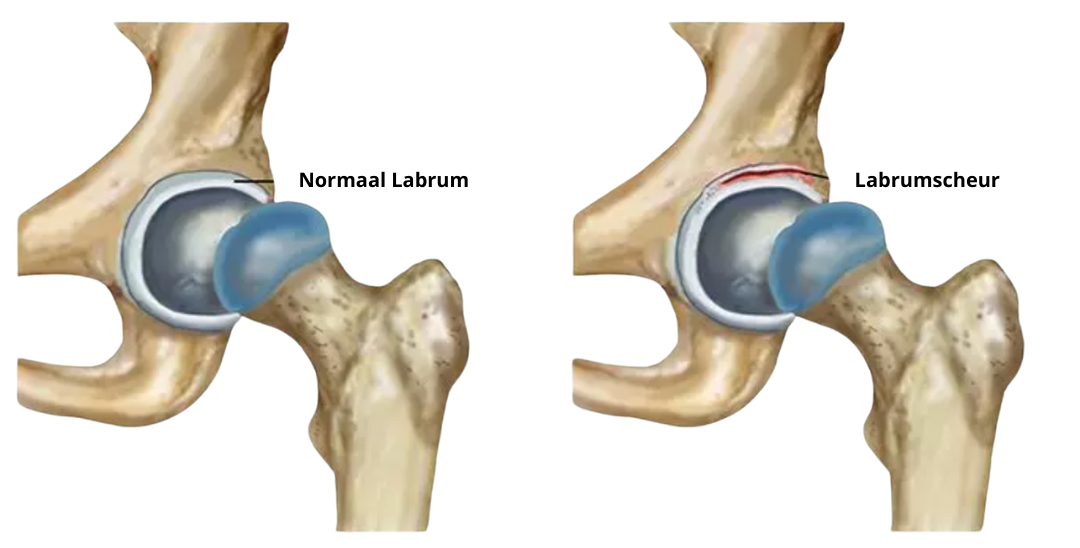Heup- en Liesklachten | Flow Fysio