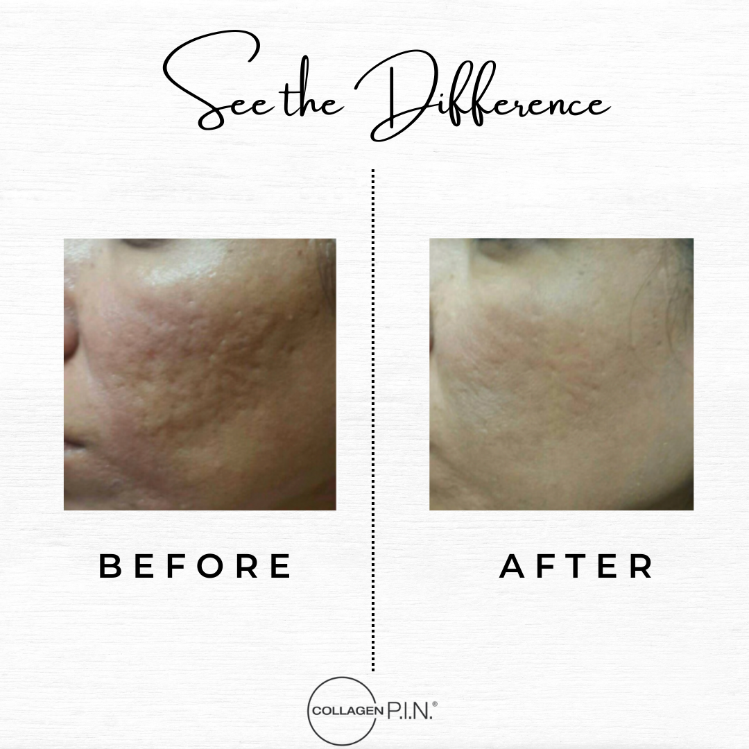 Xeomin | Rockwall, Tx | Derm Revival