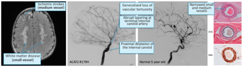 Signs & Symptoms ∙ ACTA2 Alliance ∙ Foundation for Multisystemic Smooth ...