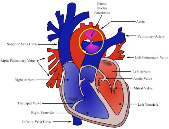 Signs & Symptoms ∙ ACTA2 Alliance ∙ Foundation for Multisystemic Smooth ...