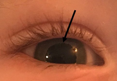 Signs & Symptoms ∙ ACTA2 Alliance ∙ Foundation for Multisystemic Smooth ...