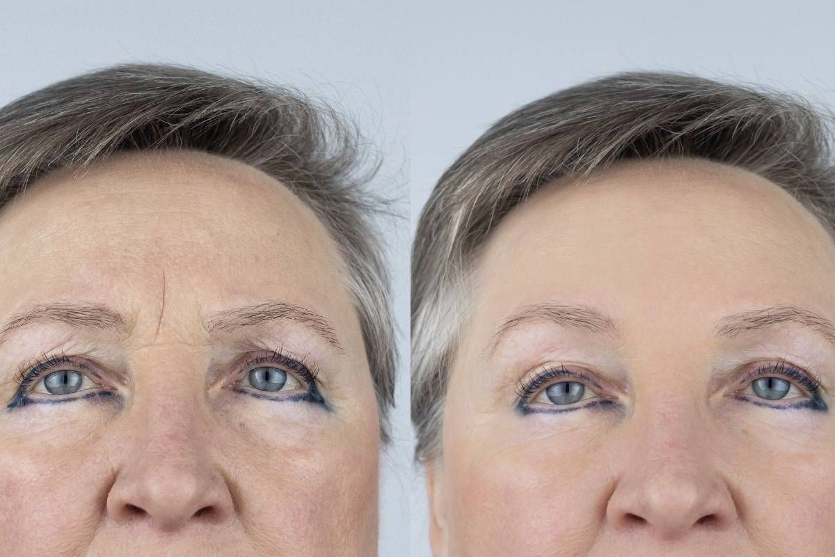 Seven Days of Botox: What to Expect? | Modern Dermatology of KY