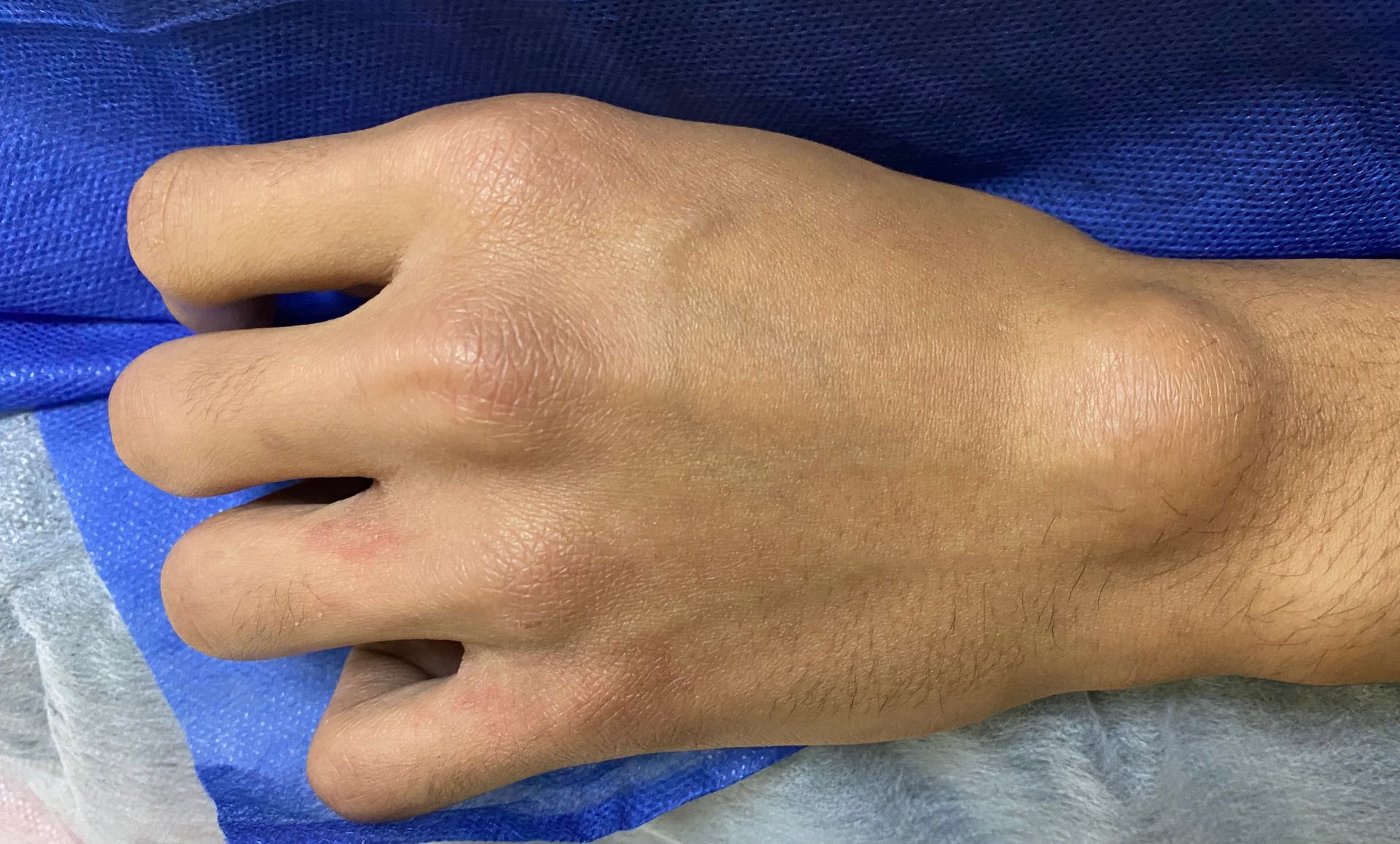 Cistos Sinoviais no punho: o que são?