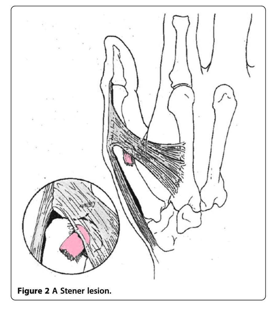 A famigerada lesão de Stener: entenda sobre o assunto