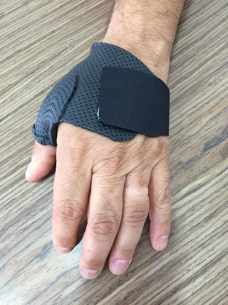 A famigerada lesão de Stener: entenda sobre o assunto