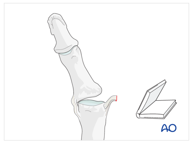 A famigerada lesão de Stener: entenda sobre o assunto
