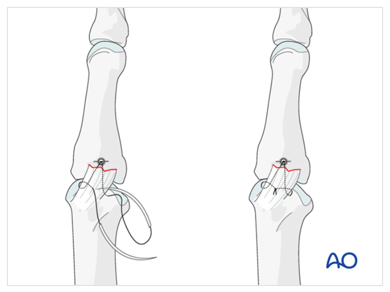 A famigerada lesão de Stener: entenda sobre o assunto