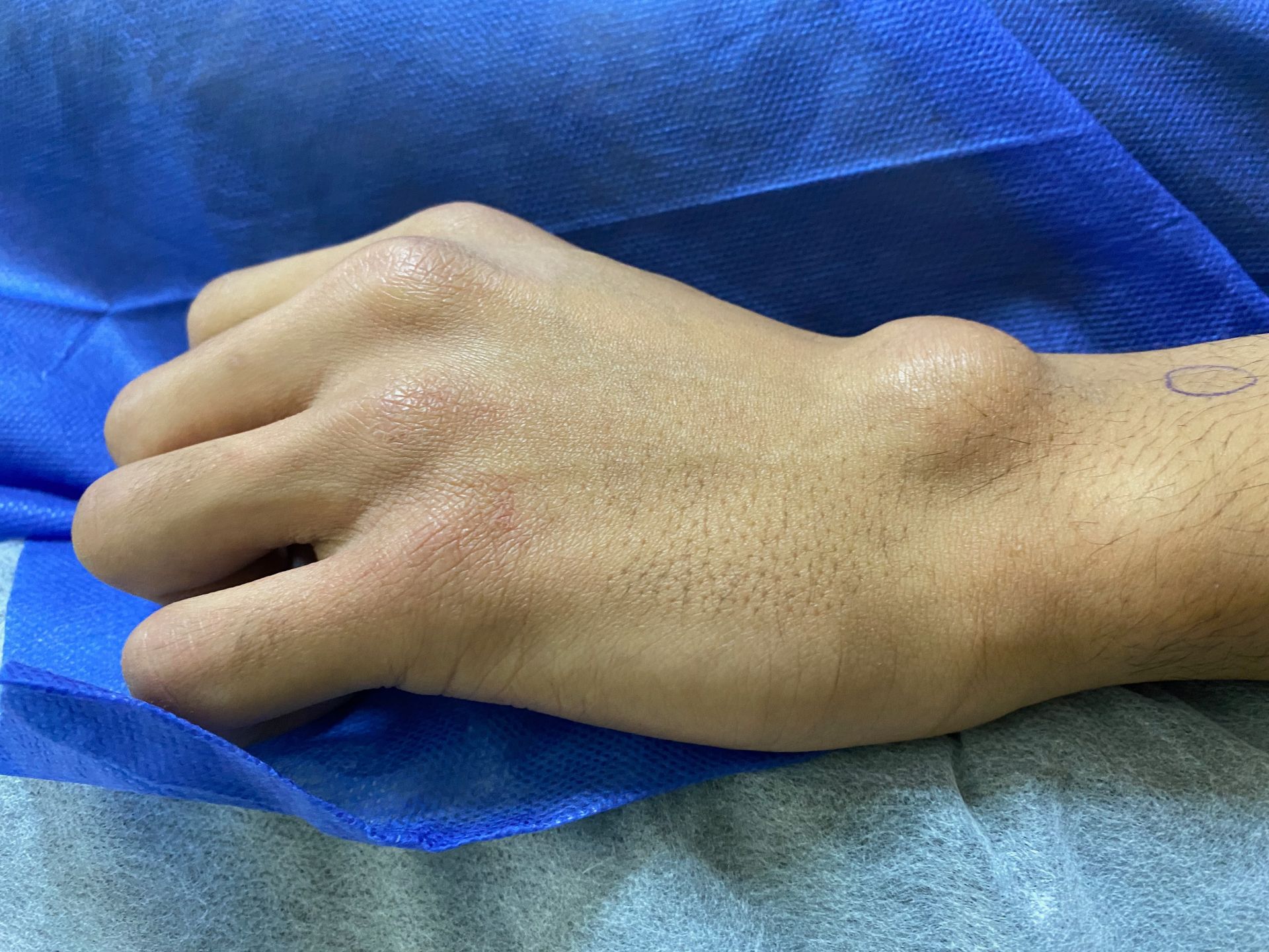 Cistos Sinoviais no punho: o que são?