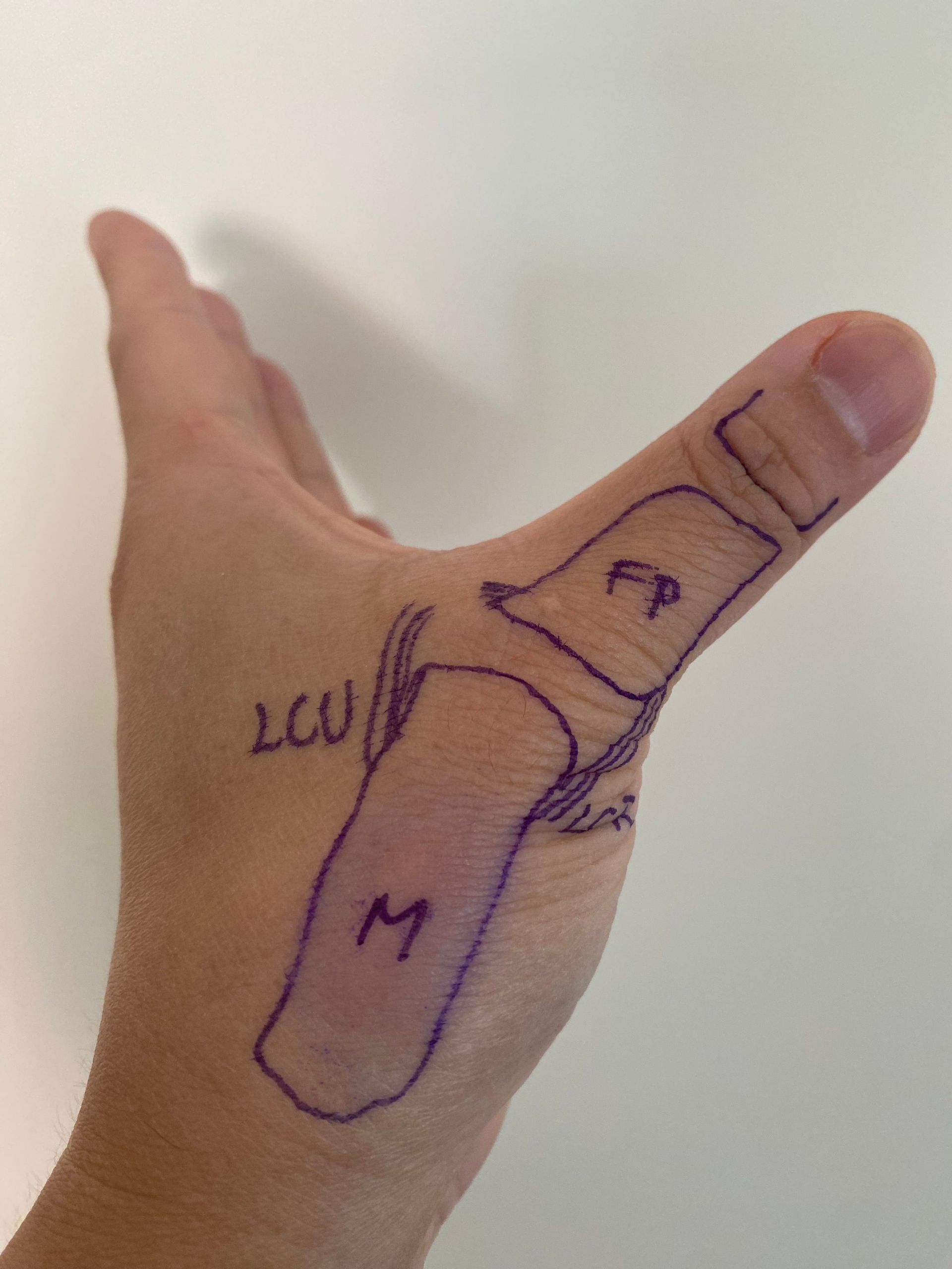 A famigerada lesão de Stener: entenda sobre o assunto