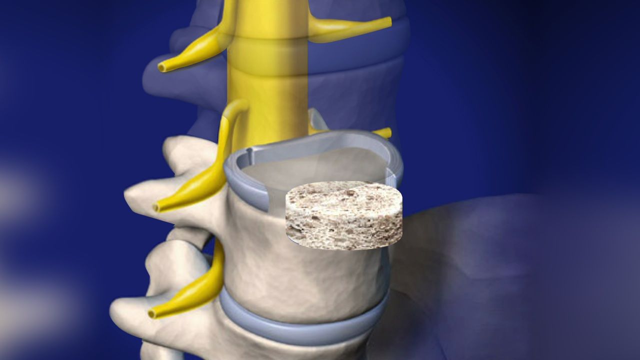 Anterior Lumbar Interbody Fusion – Brainspinemd